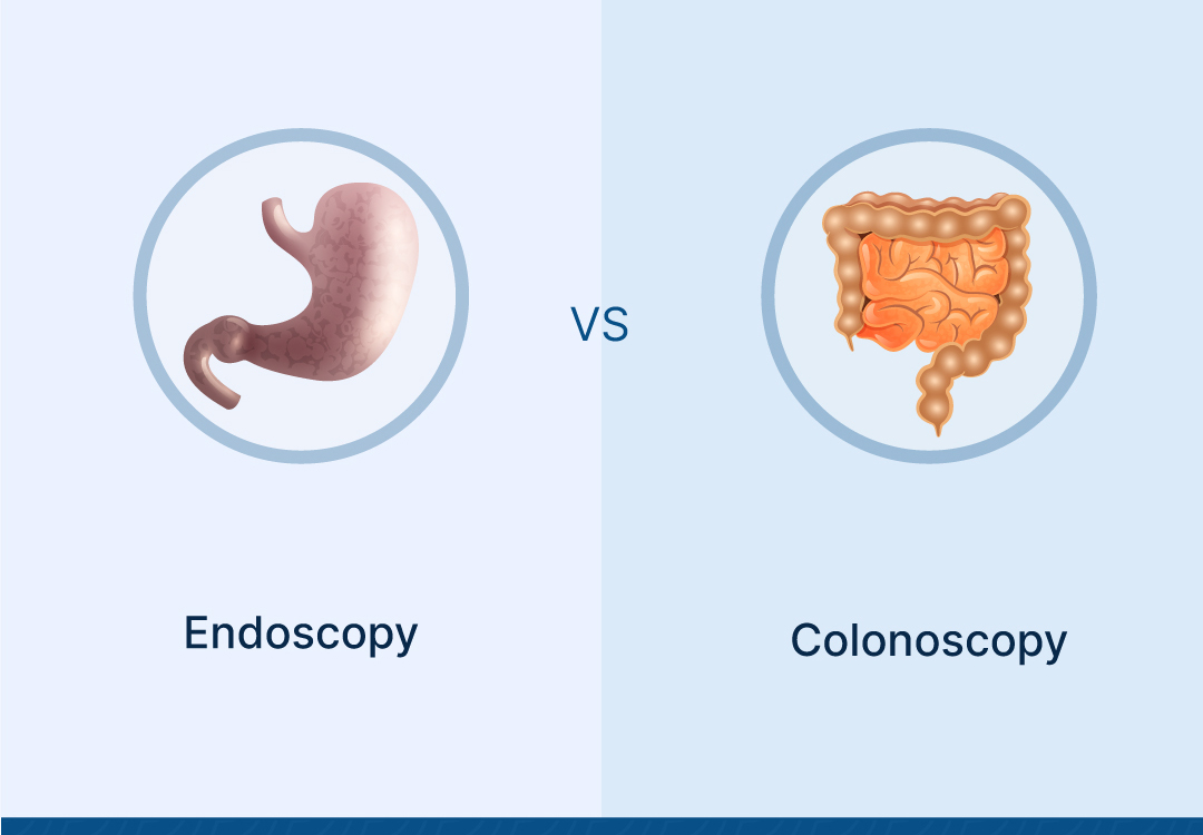 Endoscopy vs. Colonoscopy: Which GI Test Do You Need? - Alina Medical ...
